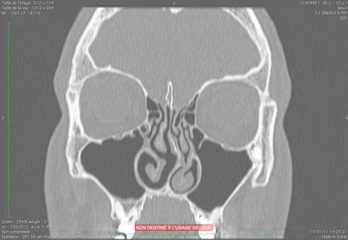 deviation-septale-gauche - Orl Nice - Docteur Laurent Tardivet ...